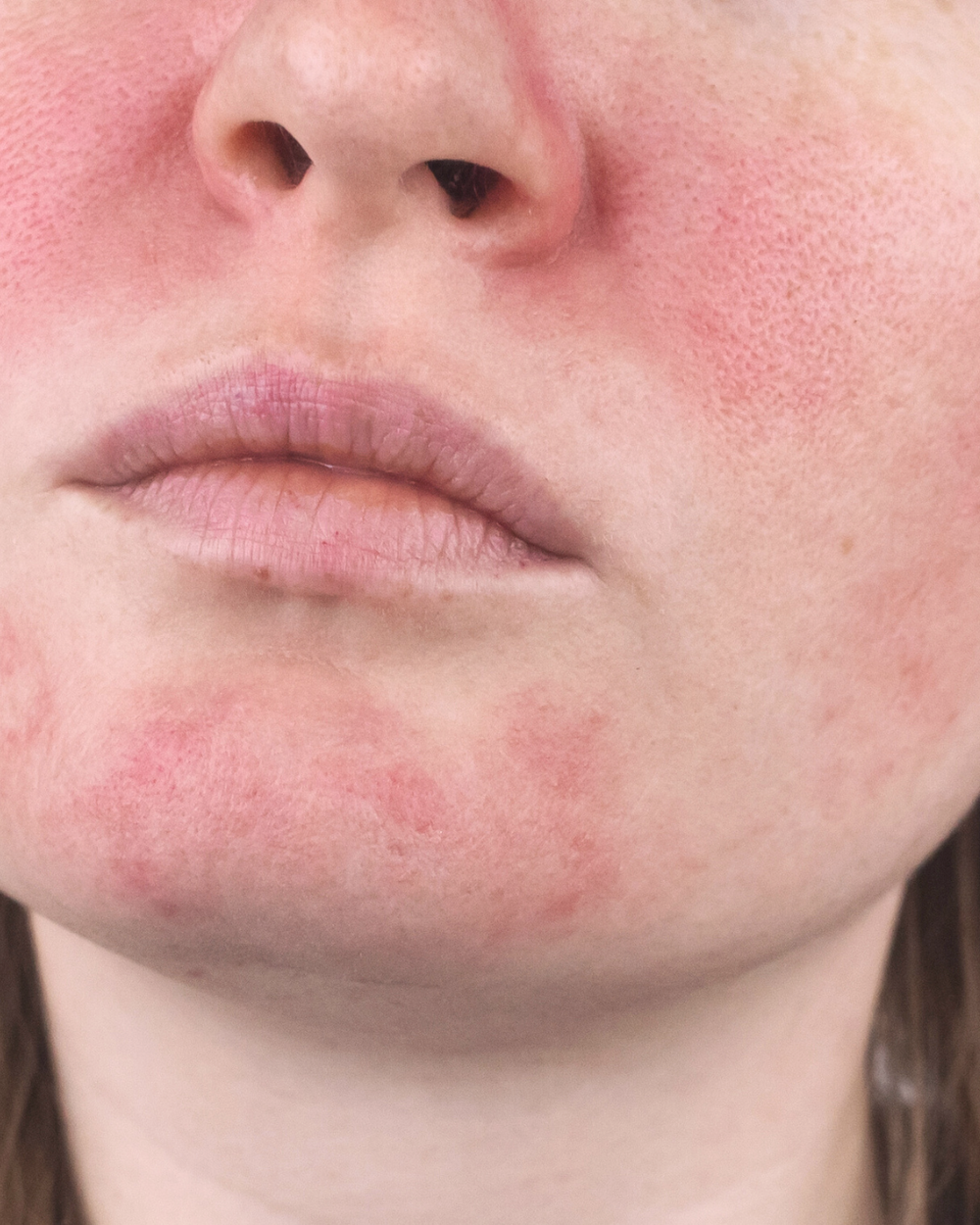 Teepuuöljy ja sen vaikutukset | Flow Cosmetics